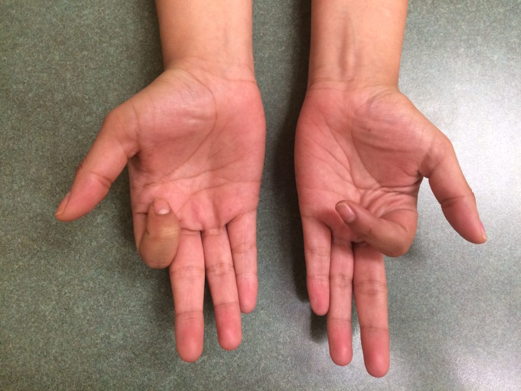 P1 Derotation Osteotomy – Expert Hand Surgeons in the East Bay