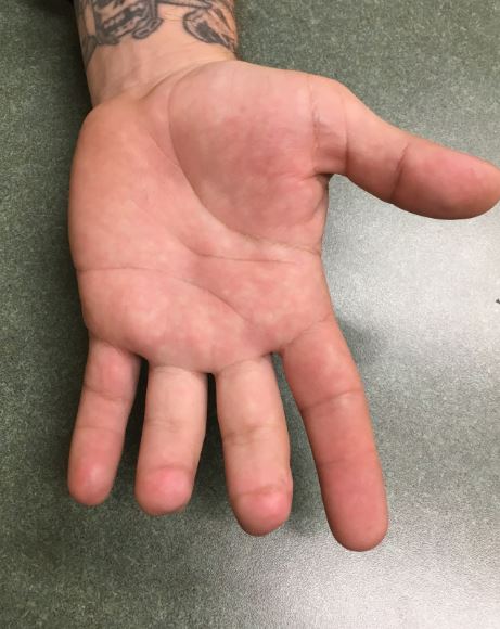 Finger Crush – Franko – Expert Hand Surgeons in the East Bay