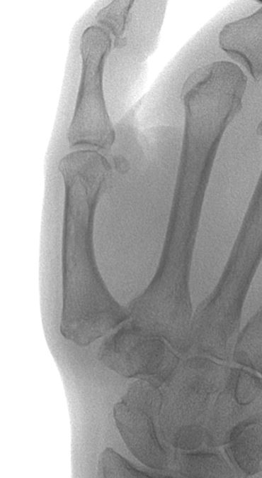 Thumb Arthritis – Expert Hand Surgeons in the East Bay