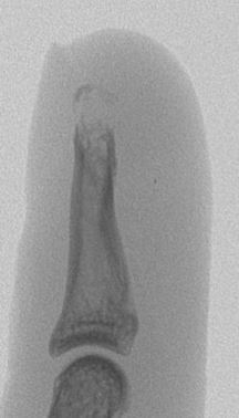 Nail Bed Avulsion – Expert Hand Surgeons in the East Bay