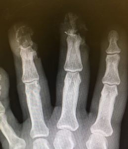 Finger Crush – Franko – Expert Hand Surgeons in the East Bay