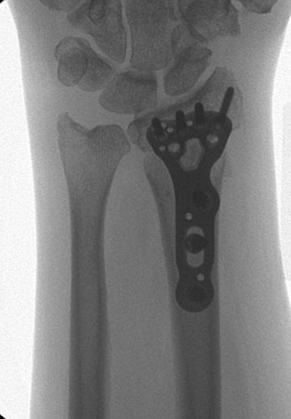 Distal Radius Osteotomy – Expert Hand Surgeons in the East Bay