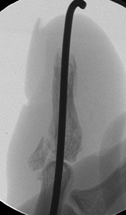 Mallet Finger CRPP – Expert Hand Surgeons in the East Bay