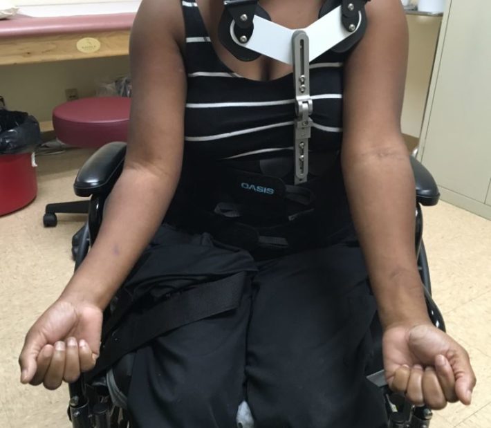 Humerus ORIF – Expert Hand Surgeons in the East Bay
