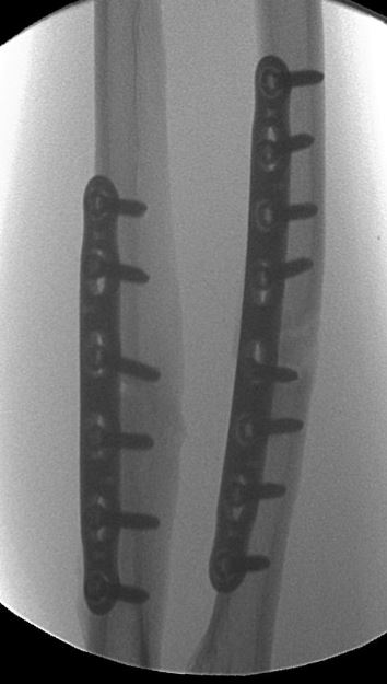 Radius/Ulna ORIF – Expert Hand Surgeons in the East Bay