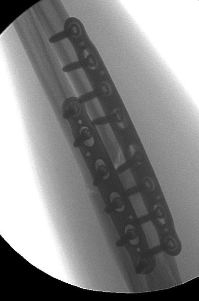 Radius/Ulna ORIF – Expert Hand Surgeons in the East Bay