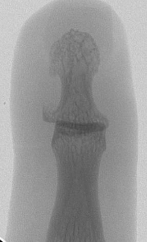 Mallet Finger CRPP – Expert Hand Surgeons in the East Bay