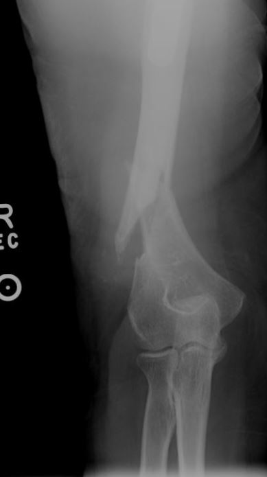 Humerus Nonunion ORIF – Expert Hand Surgeons in the East Bay