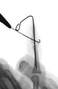 Mallet Finger CRPP – Expert Hand Surgeons in the East Bay