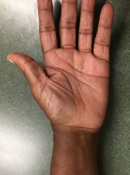 Steroid Skin Blanching – Expert Hand Surgeons in the East Bay