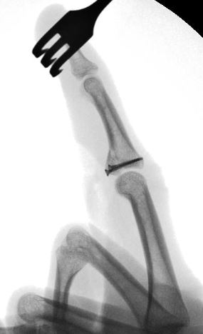 PIP Joint ORIF – Expert Hand Surgeons in the East Bay