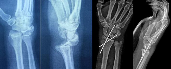 Dislocation images – Expert Hand Surgeons in the East Bay