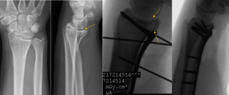 Volar Shear Fragment Pin – Expert Hand Surgeons in the East Bay