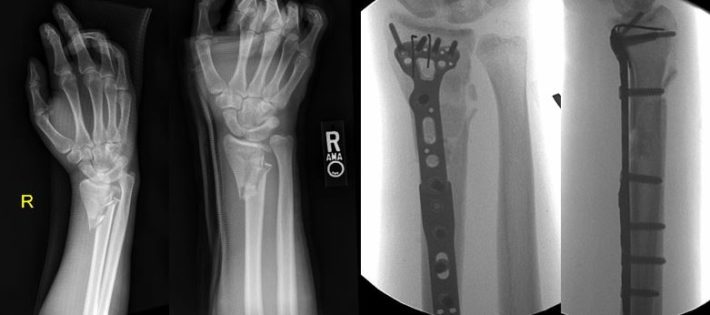 Complex Forearm Fractures - East Bay Hand Medical Center - Best Hand ...