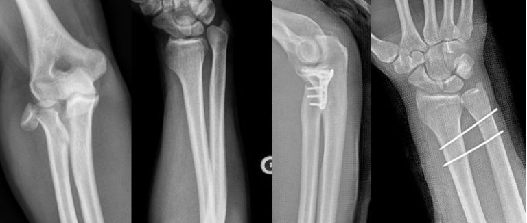 Complex Elbow Fractures - East Bay Hand Medical Center - Best Hand Surgeons