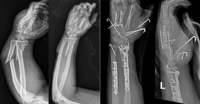 Complex Forearm Fractures - East Bay Hand Medical Center - Best Hand ...