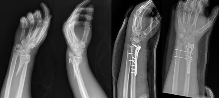 Complex Forearm Fractures - East Bay Hand Medical Center - Best Hand ...