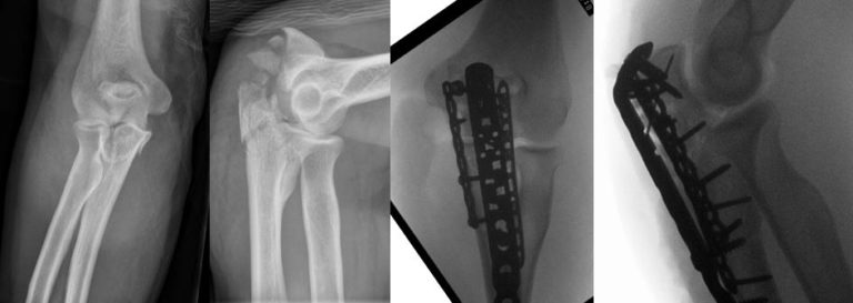 Complex Elbow Fractures - East Bay Hand Medical Center - Best Hand Surgeons