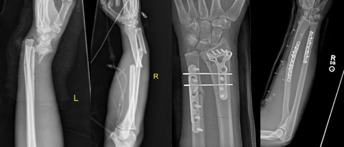 Complex Forearm Fractures - East Bay Hand Medical Center - Best Hand ...