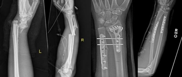 Complex Forearm Fractures - East Bay Hand Medical Center - Best Hand ...