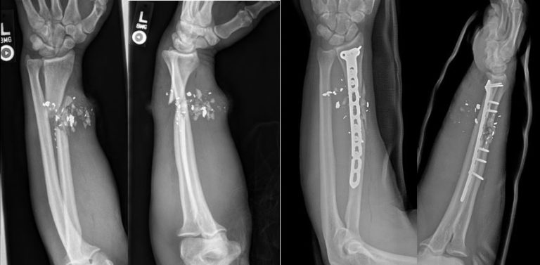 Complex Forearm Fractures - East Bay Hand Medical Center - Best Hand ...