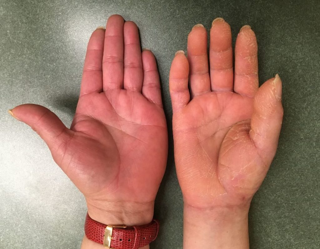 About Dr. Orrin Franko – Expert Hand Surgeons in the East Bay